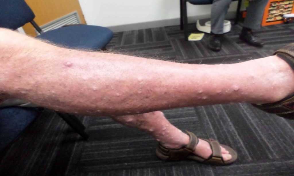 Guess the Diagnosis – Answer Revealed - Infinity Pathology