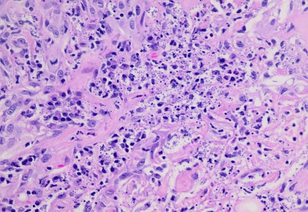 Guess the Diagnosis – Answer Revealed - Infinity Pathology